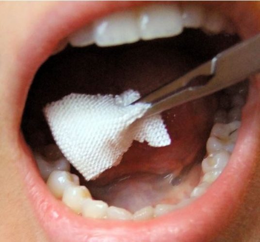 Guide To Wisdom Tooth Removal In Singapore - Extraction, Costs and Recovery