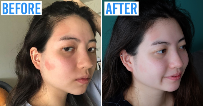 How I Reduced Redness On My Overly Sensitive Skin Under A Month