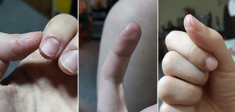 How to quit nail biting - kicking a 17-year-old habit because of COVID-19