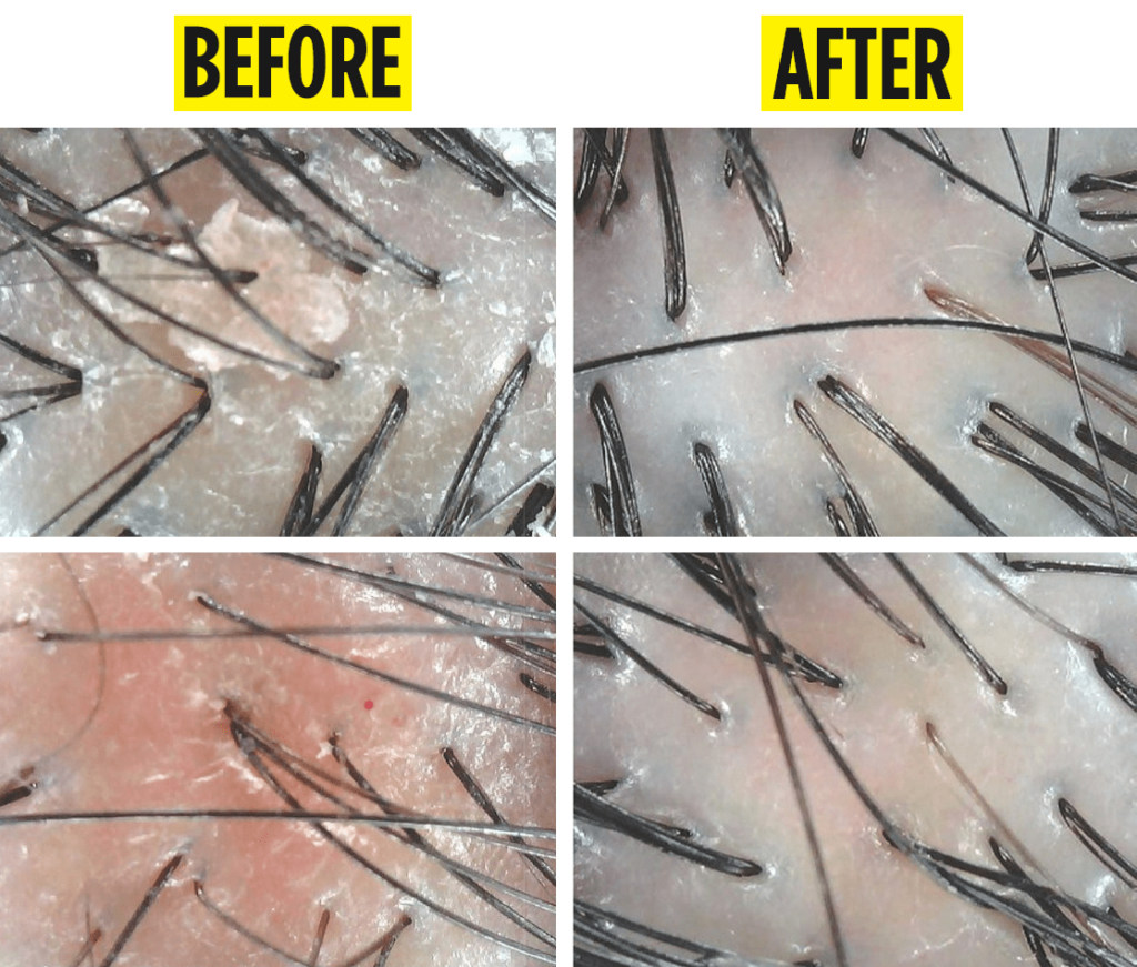 PHS Hairscience Dandruff Treatment - visible results after 1 session