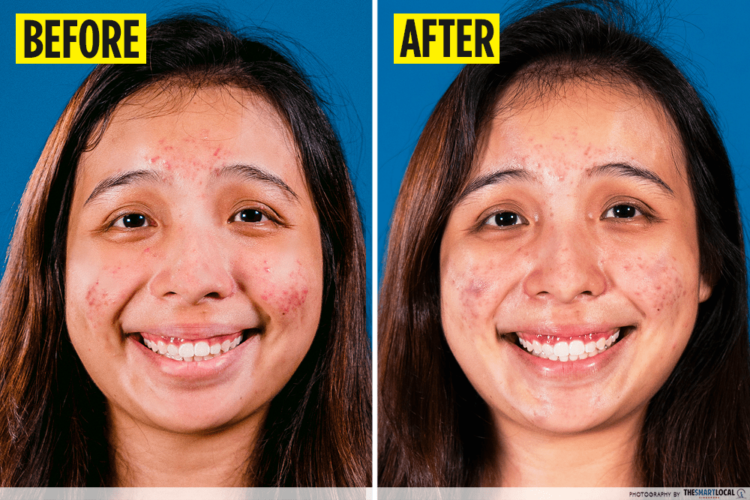 Acne Treatment Product in Singapore - La Roche-Posay Trial & Review